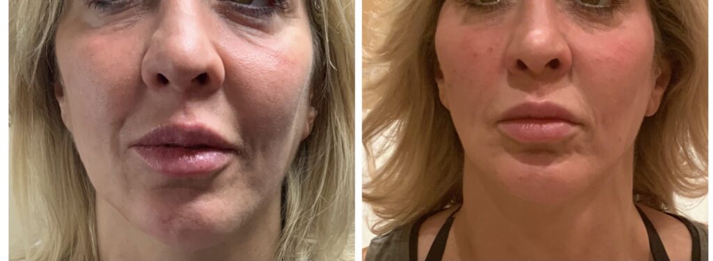 Botox and Fillers – J Madison Spa